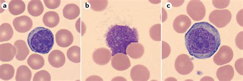 Prolymphocyte