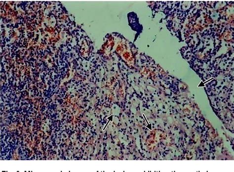 Figure 3 From Bilateral Radicular Cyst A Rare Case Presentation