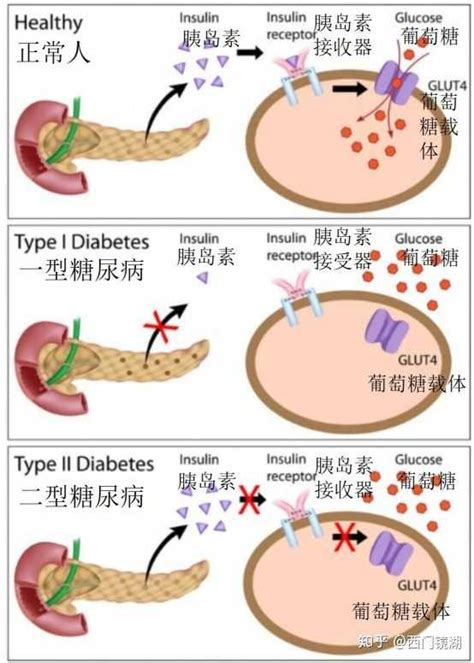 如何能够降低胰岛素抵抗？ 知乎