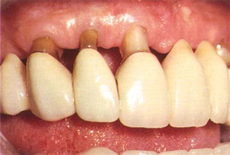 9 Tooth Preparation Gingival Retraction Hydrocolloid Impression