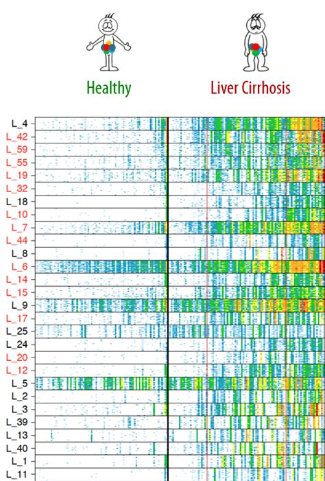 Human Gut Microbiome Alterations In Liver Cirrhosis Metagenopolis