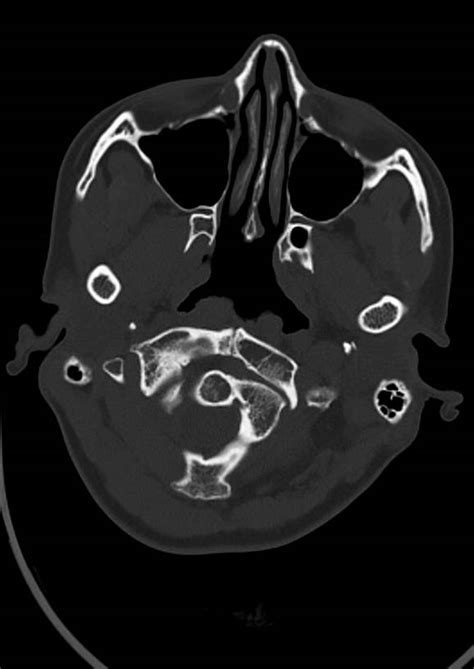 Vertebral Segmentation Defects Image
