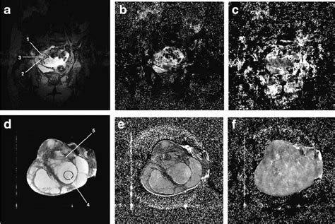 Case 1 Primary Mucinous Carcinoma Of The Ovary A T 2 Weighted In Vivo