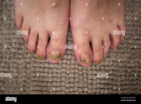 Onicomicosis infección micótica de las uñas con dos pies Fotografía de
