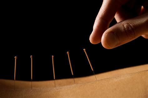 About Acupuncture For Infertility Headaches Cosmetic And More