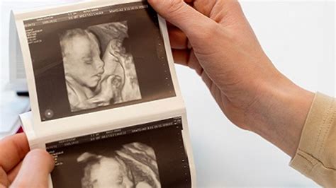 Ley De Protección De La Vida Salva Hasta Ahora 10000 Bebés