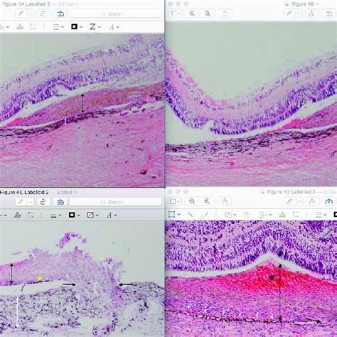 Histopathology Of Type 2 Choroidal Neovascularization Cnv A A