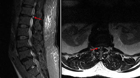 Lumbar Synovial Cyst