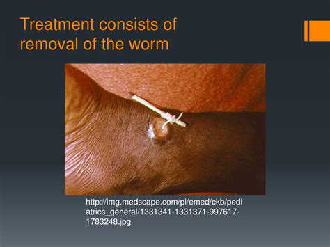 Ppt Guinea Worm Disease Powerpoint Presentation Free Download Id