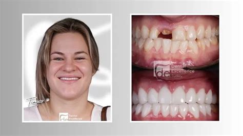 What Do Dental Implants Look Like Dental Excellence Turkey Blog