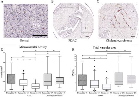Stroma Is Hypovascular In Pdac But Not Cholangiocarcinoma Aec Cd31