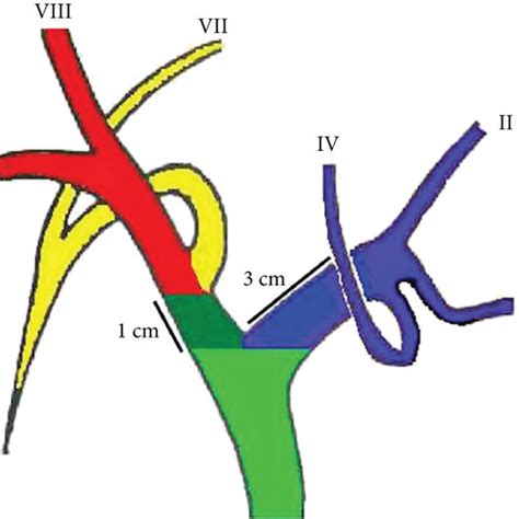 Bismuth Type Iiia Hilar Stricture A Three Uncovered Self Expandable