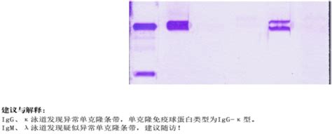 诊断多发性骨髓瘤？没那么简单！ 丁香园