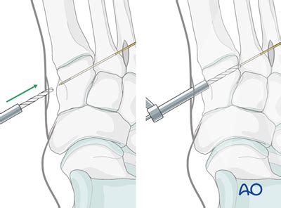 Dynamic Fixation Of Ruptured Lisfranc Ligament