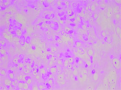 Skeletal Conventional Chondrosarcoma Contained One Neoplastic Lobule