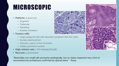 Lung Large Cell Neuroendocrine Carcinoma Pptx