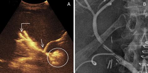 Normal T Tube Ceus Cholangiography Findings In A 54 Year Old Man Who Download Scientific