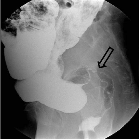 Barium Enema Shows Diffuse Luminal Narrowing With Mucosal Nodularity In