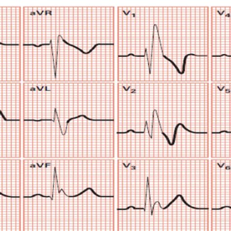Morphology Of Wpw Arrhythmia Figure Shows Various Morphologies Of Wpw