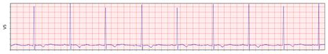 Interpretable Ecg Classification With 1d Vision Transformer Yoni