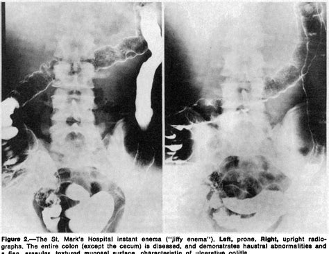 Differential Diagnosis Of Crohns Disease And Ulcerative Colitis At Sofia Symon Blog