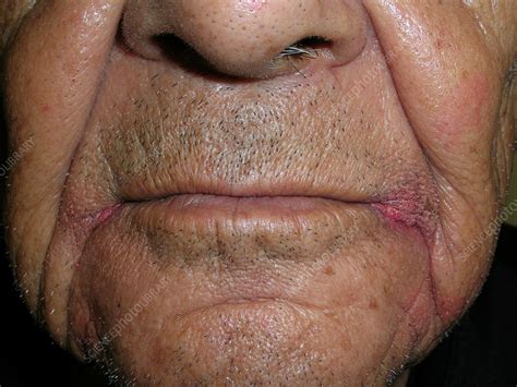 Angular Cheilitis Stock Image C0564953 Science Photo Library