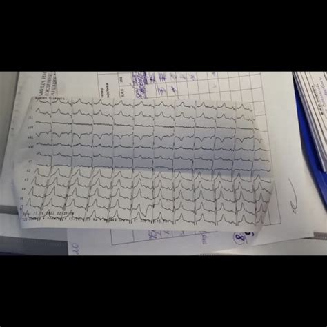 Pavel Somov On Linkedin Ecg Vasospasm Pci 17 Comments