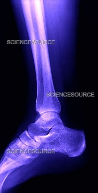 Heel X Ray Stock Image Science Source Images