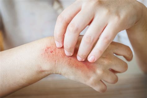 Allergic Reaction Rash On Hands And Arms