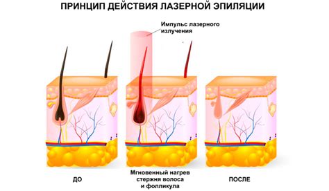 Лазерные эпиляторы - купить домашние лазерные эпиляторы от 18000 руб.