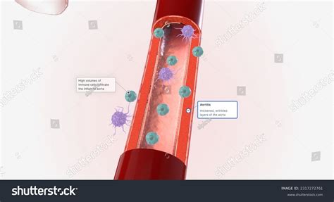 721 Infiltration Into Cells 图片、库存照片和矢量图 Shutterstock