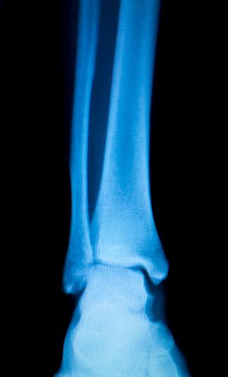 Xray 발 뒤꿈치 발목 테스트 검사 결과 부상 수술 후 정형 외과 티타늄 금속 임 플 란 트 나사를 보여주는 X 레이에 대한