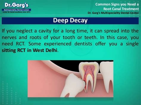 Common Signs You Need A Root Canal Treatment