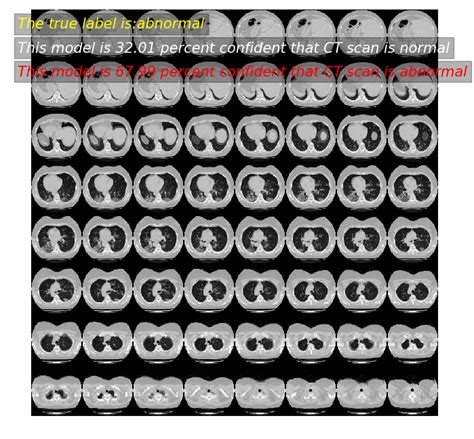 mosmeddata 新冠肺炎胸部 ct扫描数据集上基于3d cnn实现二分类 使用文档 paddlepaddle深度学习平台