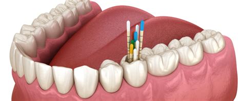 What Are Endodontic Files Made Of A Comprehensive Guide