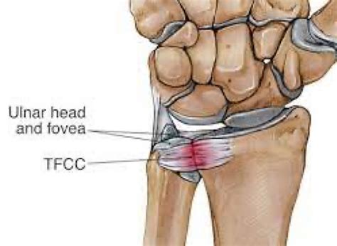 A Look At Tfcc Injuries Floyd Lebatie Physiotherapy