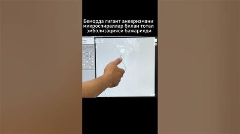 Унг урта мия артерияси М2 сегменти гигант аневризмаси Гигантская