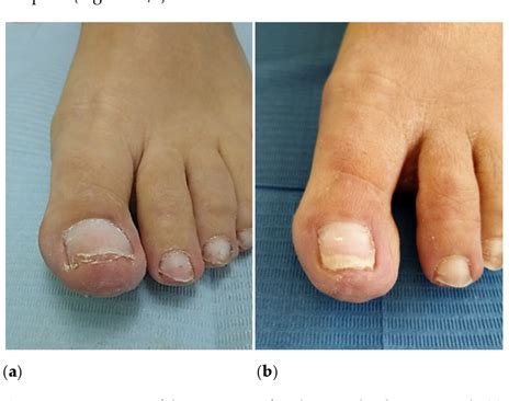Figure 1 From Hallux Partial Necrosis Associated With Antiphospholipid Syndrome The Importance