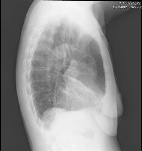 Right Middle Lobe Pneumonia Lateral