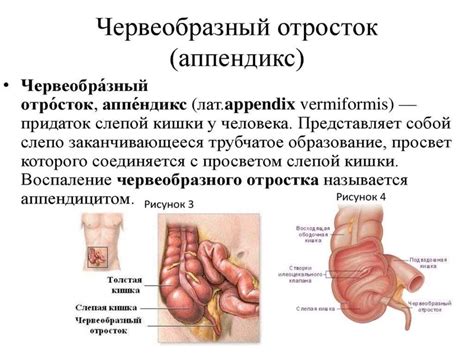 Аппендэктомия. Острый аппендицит - online presentation