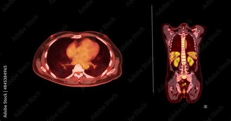 A Pet Ct Scan Reveals Cholangiocarcinoma With Suspected Metastatic