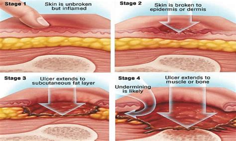 Bed Sores Pressure Ulcer Causes Stages Prevention And Pressure Ulcer Treatment