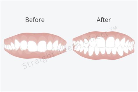 Overbite Wondering If Clear Aligners Could Fix Yours