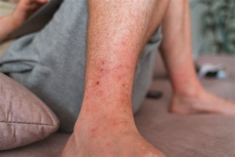 Hives Vs Eczema Whats The Difference