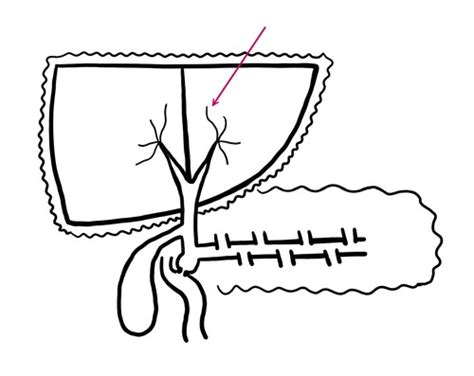 Ch 15 Biliary Tree Flashcards Quizlet