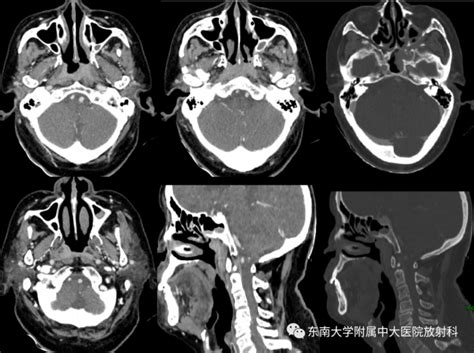 【ppt】鼻咽癌影像及分期 影像ppt