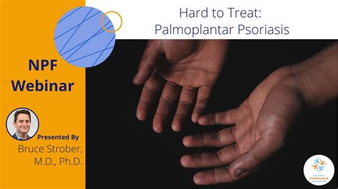 Hard To Treat Palmoplantar Psoriasis YouTube