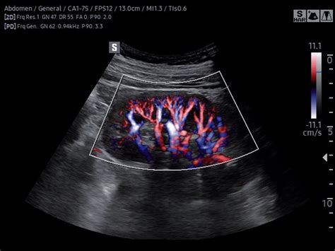 Ultrasound Of Blood Flow Through Kidneys