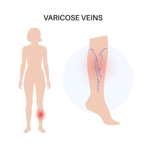 Premium Vector Varicose Veins Treatment