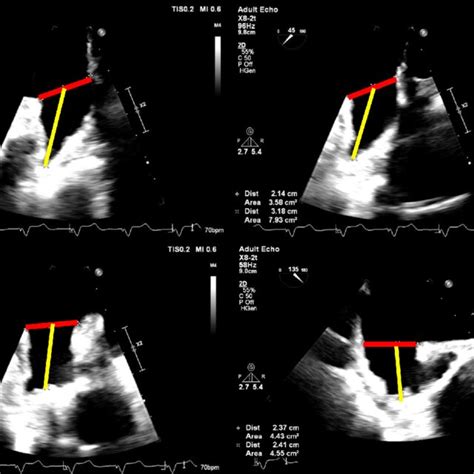 Transesophageal Echocardiogram Demonstrating Left Atrial Appendage Download Scientific Diagram